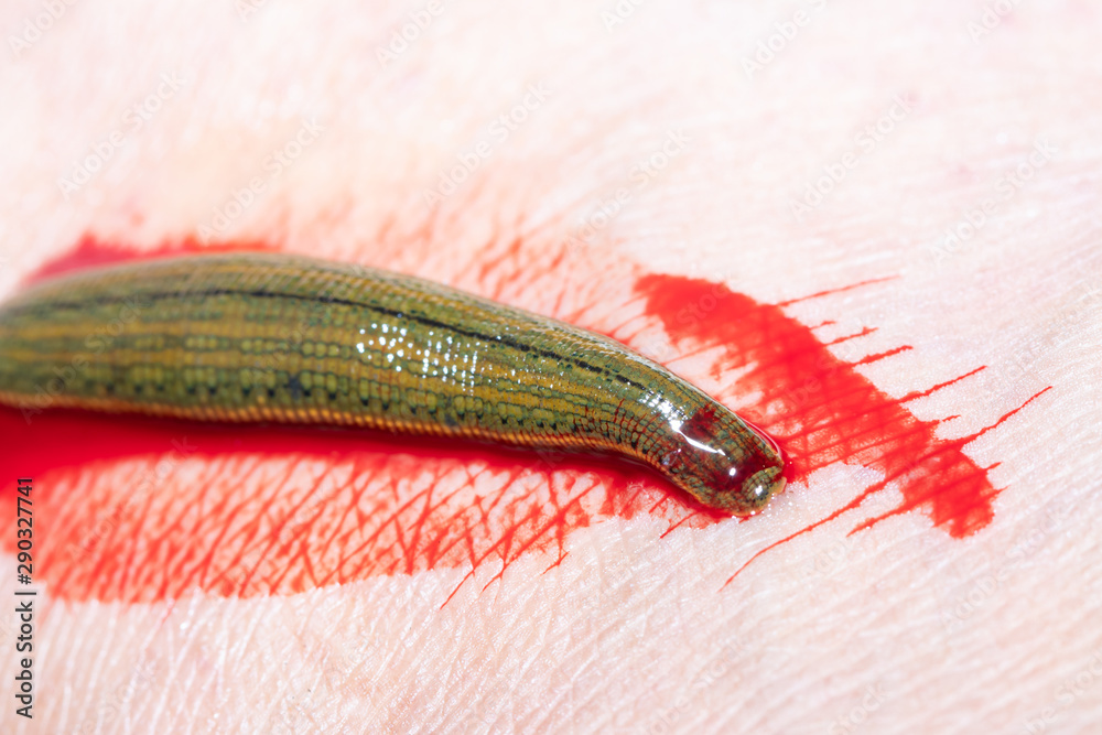 Aquatic Leech sucking blood on skin,Leeches were used in medicine from ...