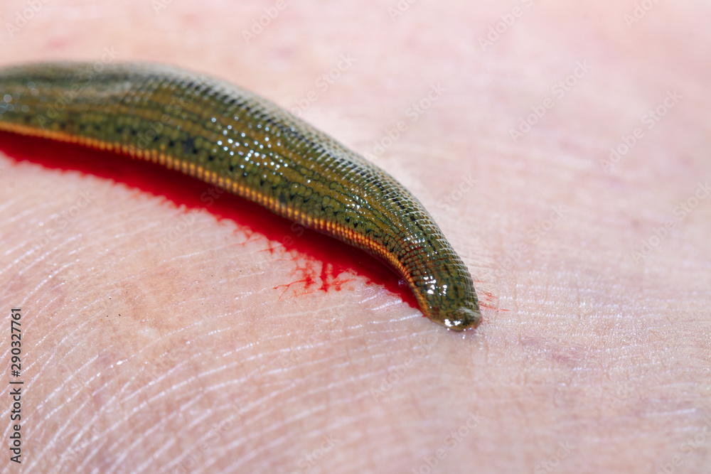 Aquatic Leech sucking blood on skin,Leeches were used in medicine from ...