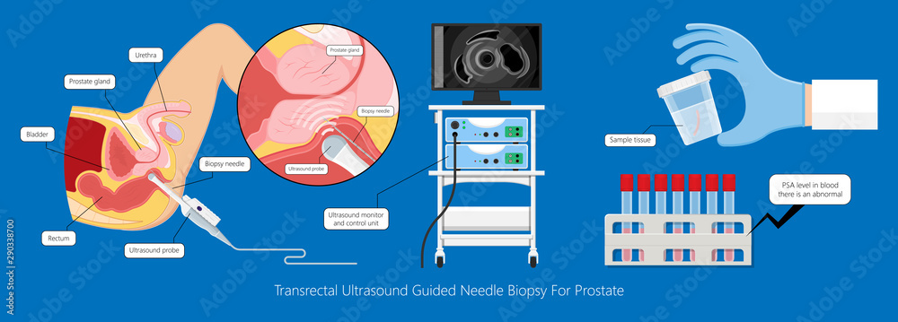 Transurethral resection of the prostate stricture urine bladder digital ...