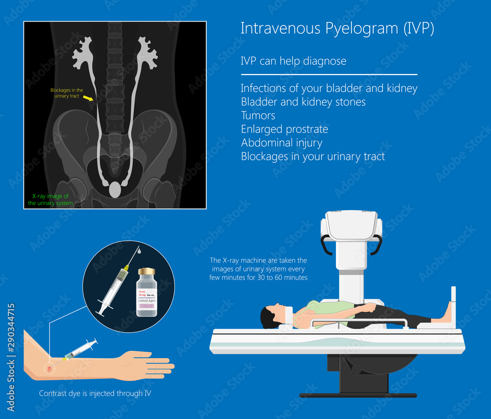 Vetor do Stock: Intravenous pyelogram IVP examination x-ray for bladder ...