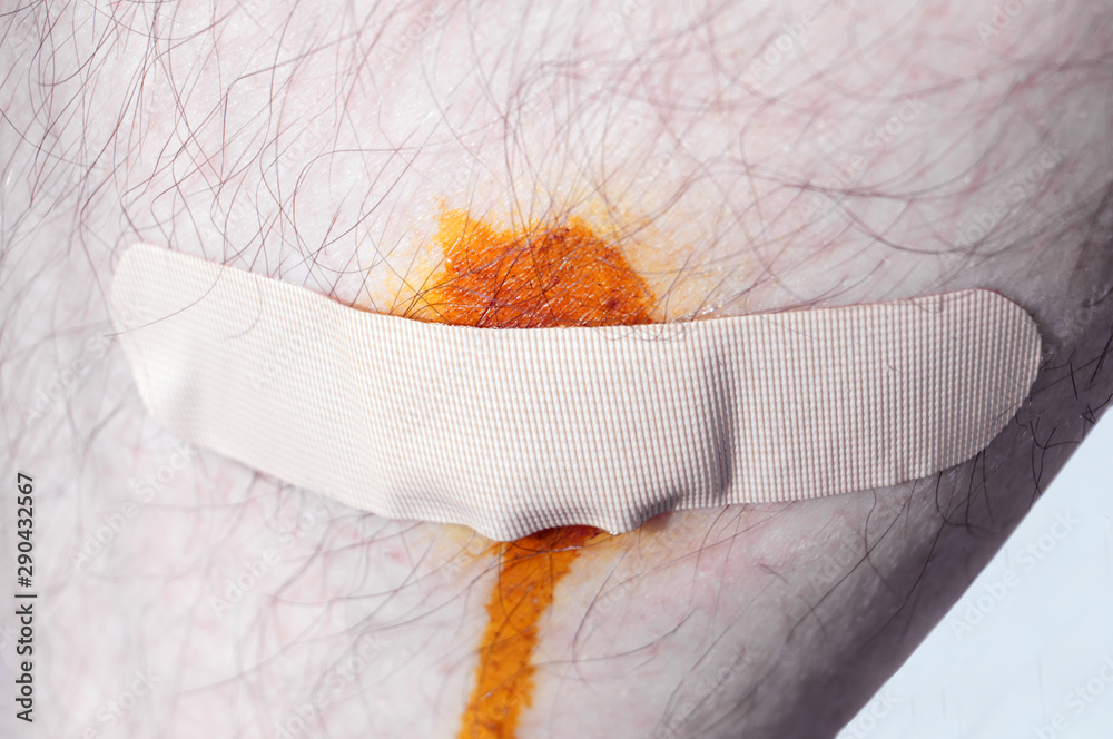 First aid. A wound on a person’s leg in an outpatient setting is ...