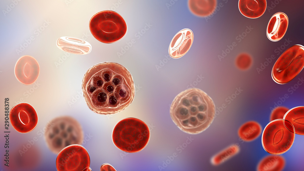 Red blood cells infected with malaria parasite, 3D illustration showing ...