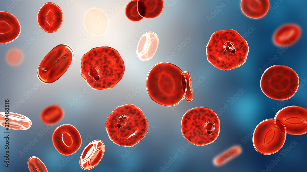 Blood smear in malaria patient. Plasmodium vivax inside red blood cell ...