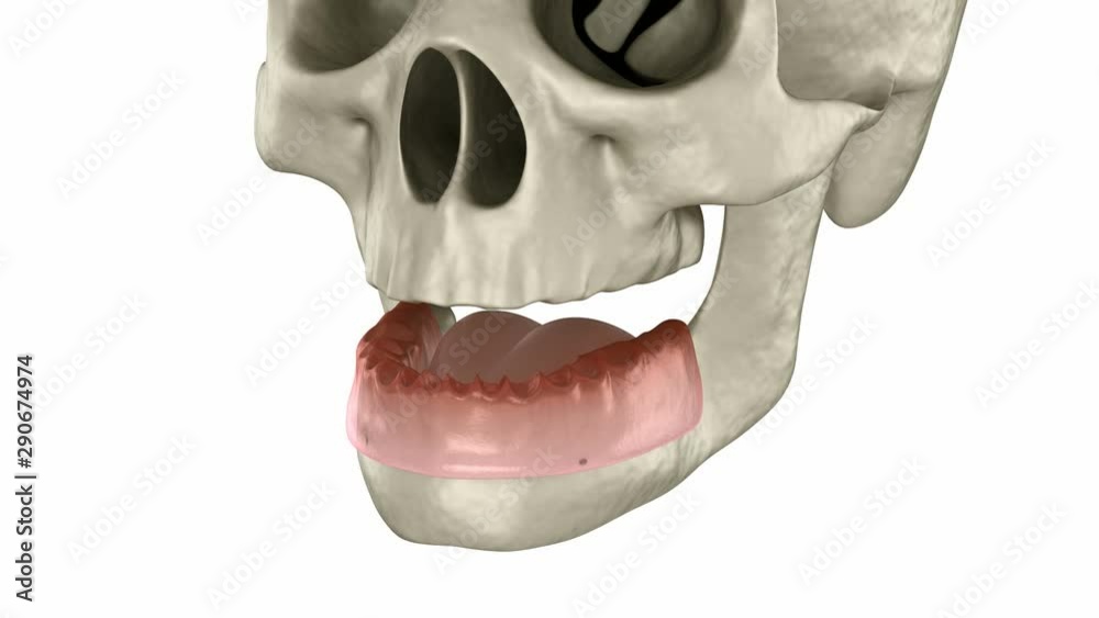 Mandibular prosthesis All on 4 system supported by implants, screw ...