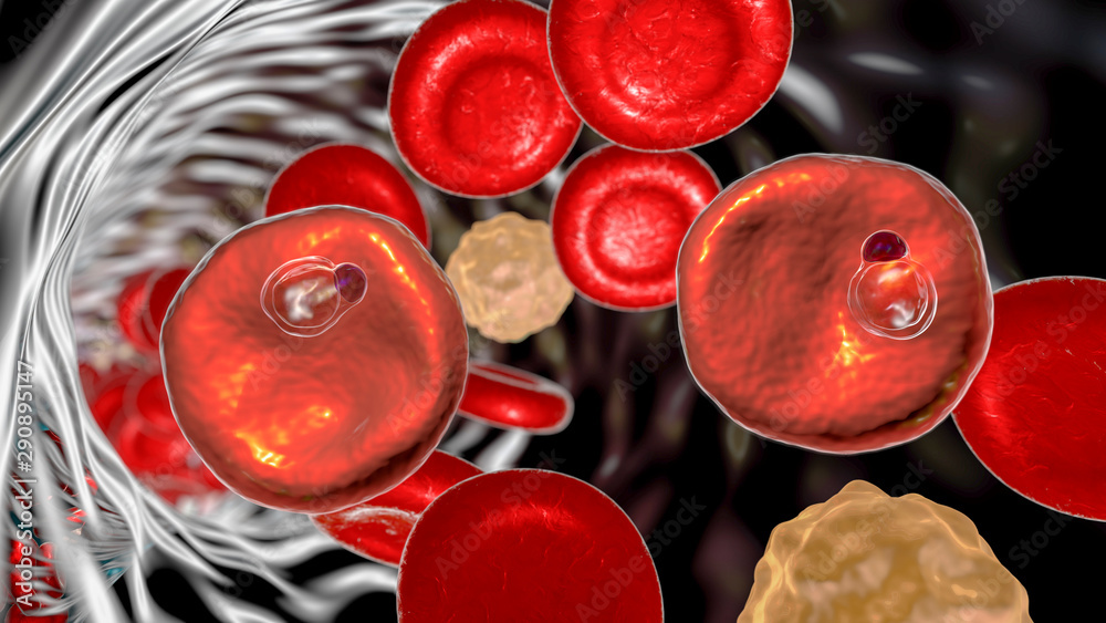 Red blood cells infected with malaria parasite Plasmodium vivax, ring ...