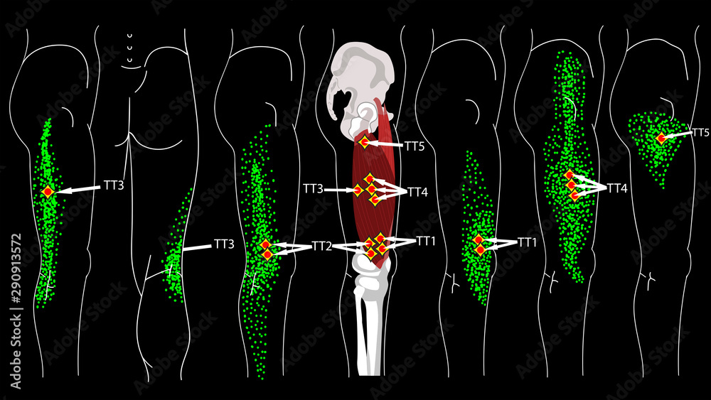 Vastus Lateralis Trigger Points. Leg pain. Release Stock Vector | Adobe Stock