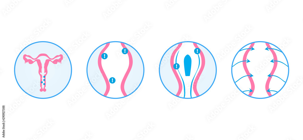 Gynecological infographics. Treatment of vaginitis suppositories ...