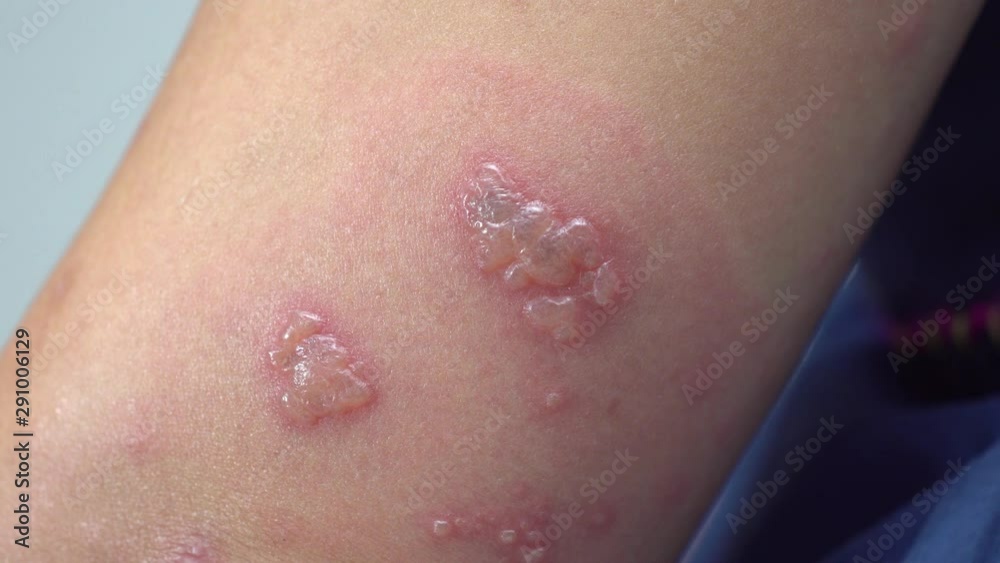 Shingles, Zoster or Herpes Zoster symptoms on arm Stock ビデオ | Adobe Stock