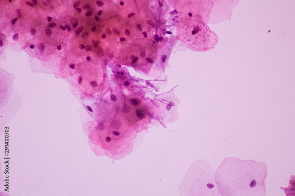 View in microscopic of Candidiasis, fungus infection (Yeast and ...