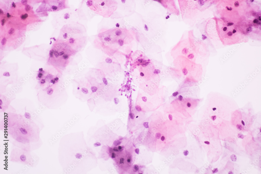 View in microscopic of Candidiasis, fungus infection (Yeast and ...