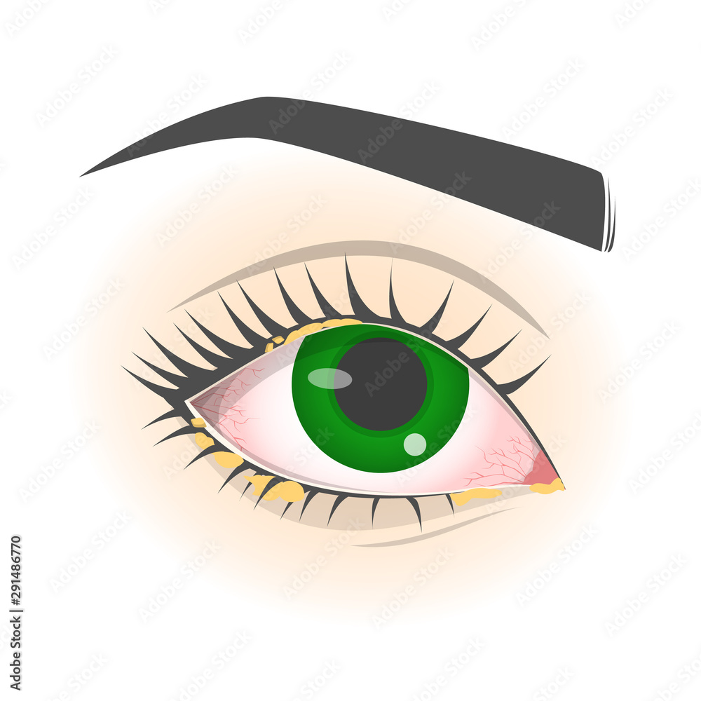 Conjunctivitis symptoms. Pink eye disease, infection and allergy Stock ...