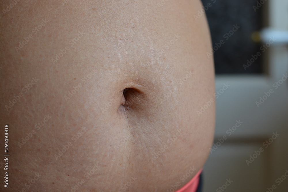 Scar on the belly button of a person after an operation Stock Photo ...