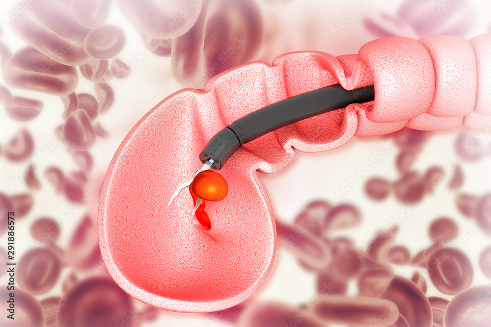 colon cancer. colonoscope in the colon. polyp removal.3d illustration ...