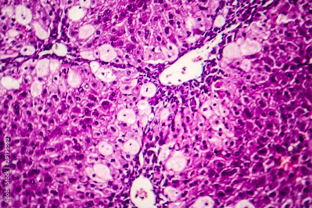 Histopathology of acute hepatitis, light micrograph, photo under ...