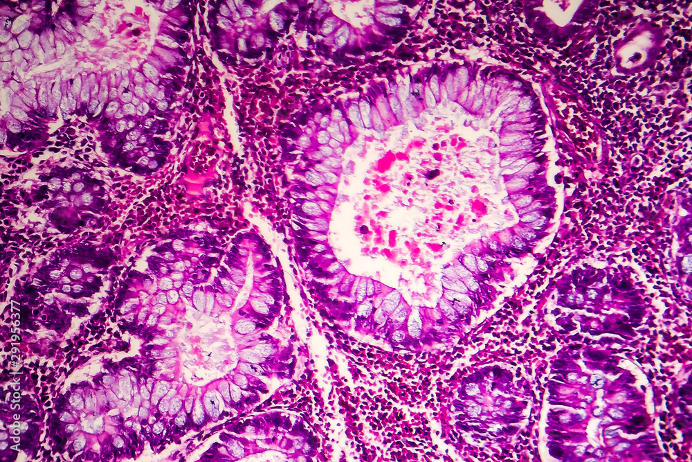 Villous colon adenocarcinoma, light micrograph, photo under microscope ...