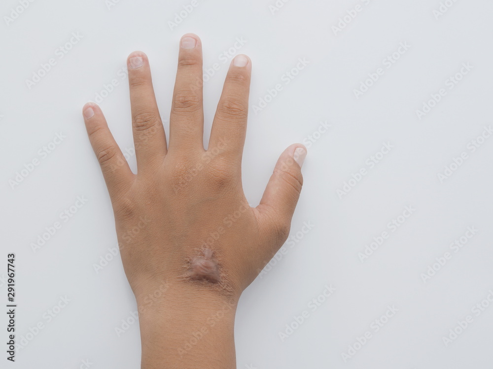 Hypertrophic scar (Keloid scar) on left hand back of young Asian woman ...