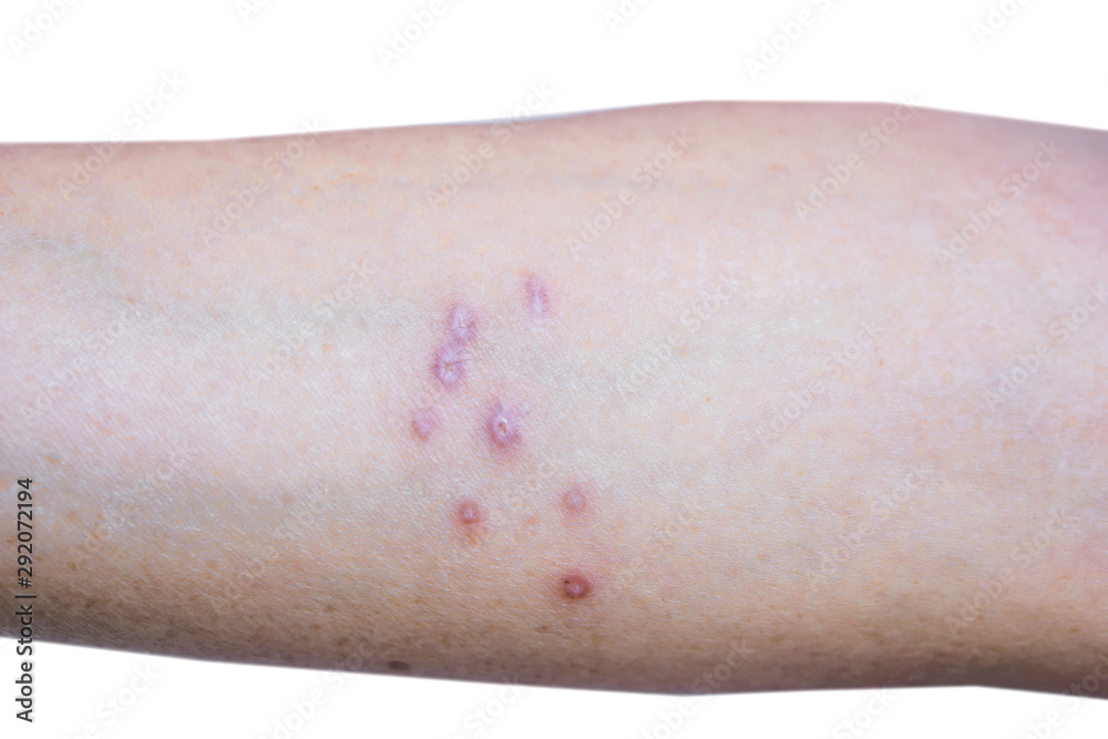 scar from skin infected Herpes zoster virus on woman arm Stock Photo ...
