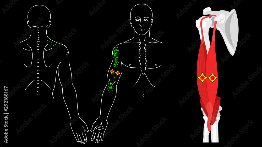 Musculus biceps brachii. Biceps trigger points and pain Stock Vector ...