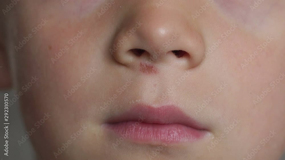 Close-up face of a little boy with a scratched nose. The child fell and ...