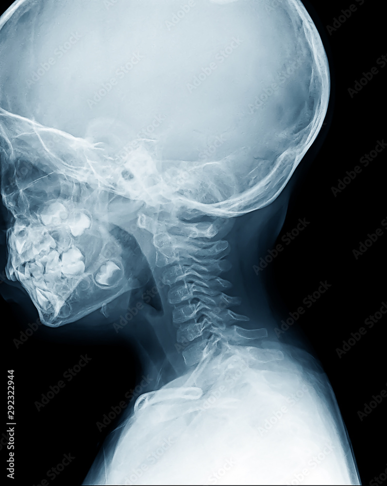 X-ray of neck and cervical side view, MRI neck x-ray Stock Photo ...