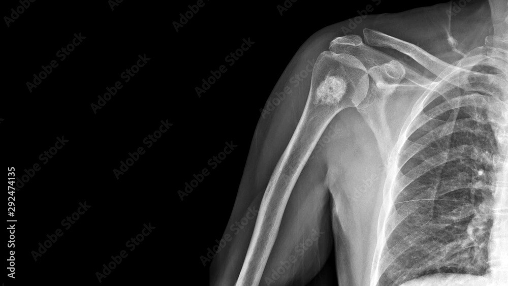 Foto de Film X ray shoulder radiograph show Enchondroma disease at arm ...