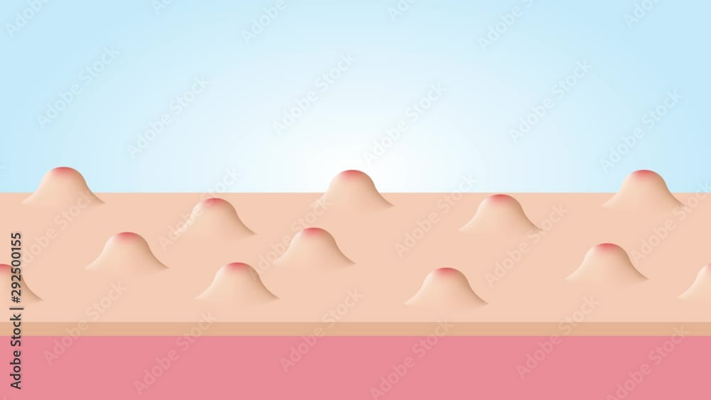 Acne and Pimples, stages of development, graphic animation Stock ビデオ ...
