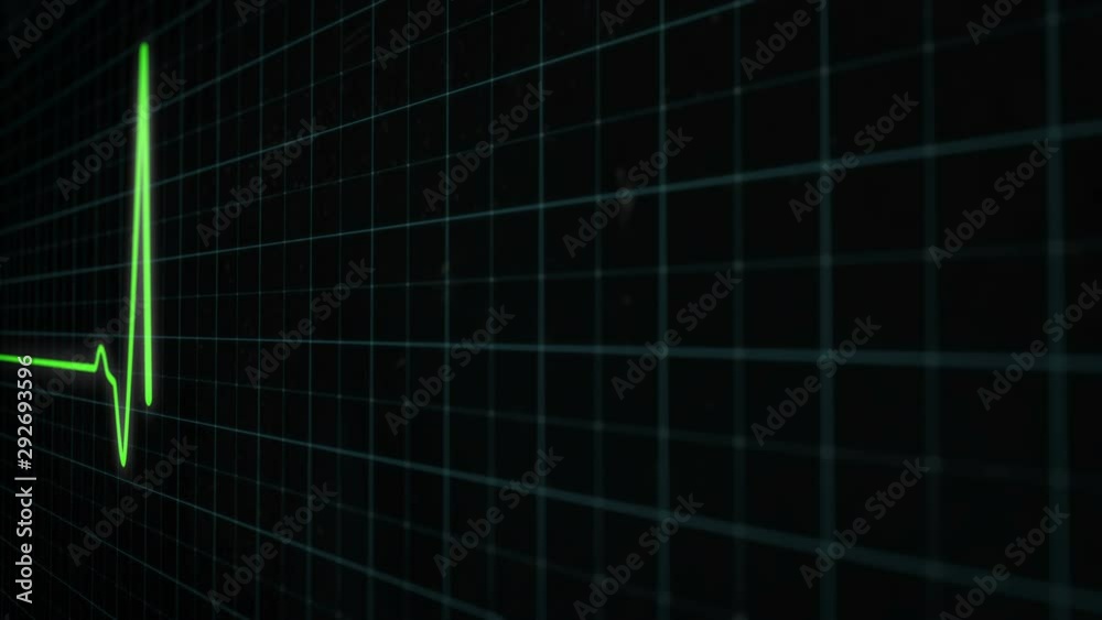Cardiac impulse sequence on medical monitor. Human heartbeat line on a ...