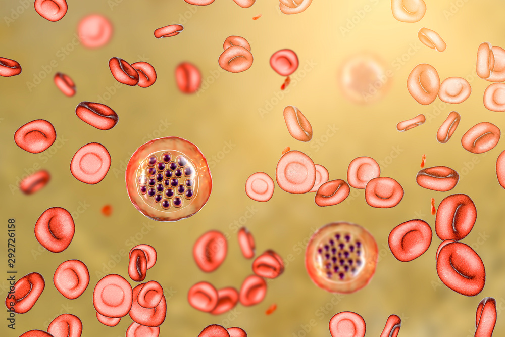 The malaria-infected red blood cells. 3D illustration showing malaria ...