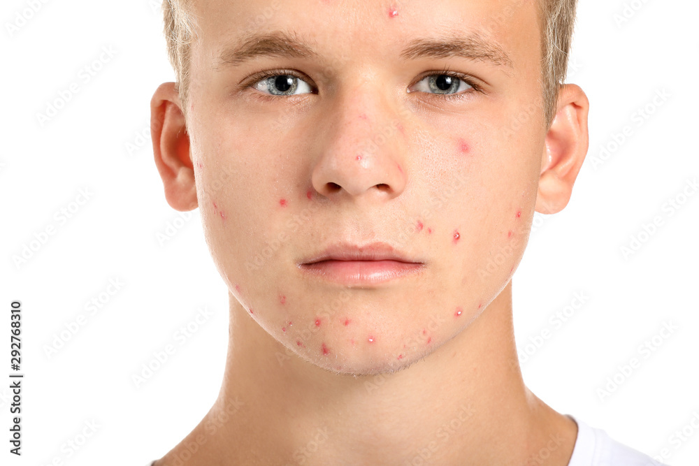 Teenage boy with acne problem on white background Stock Photo | Adobe Stock