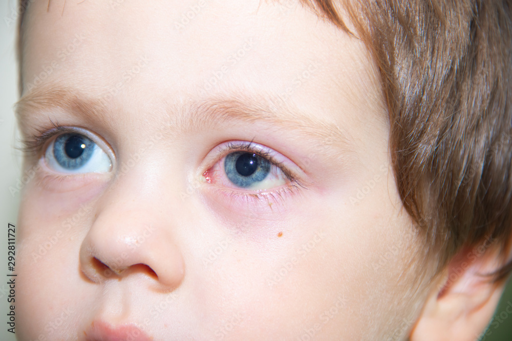 conjunctivitis in the eye of a child. Ophthalmic diseases. Red eye ...