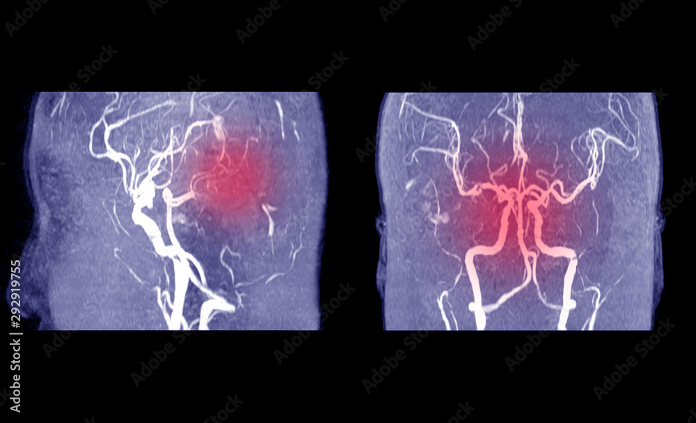 MRA brain or Magnetic resonance angiography of cerebral artery in the ...
