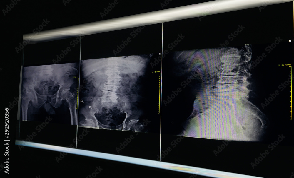 x-ray image pelvic bone and hip joint, degenerative change L4-5 lumbar ...