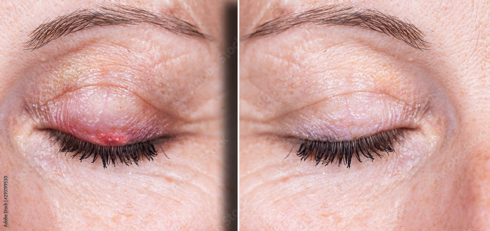 A before and after view on the closed eyelid of a woman suffering from ...