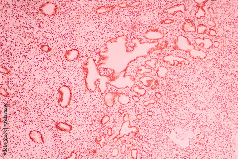 Section tissue of breast cancer view in microscopy.Ductal cell ...