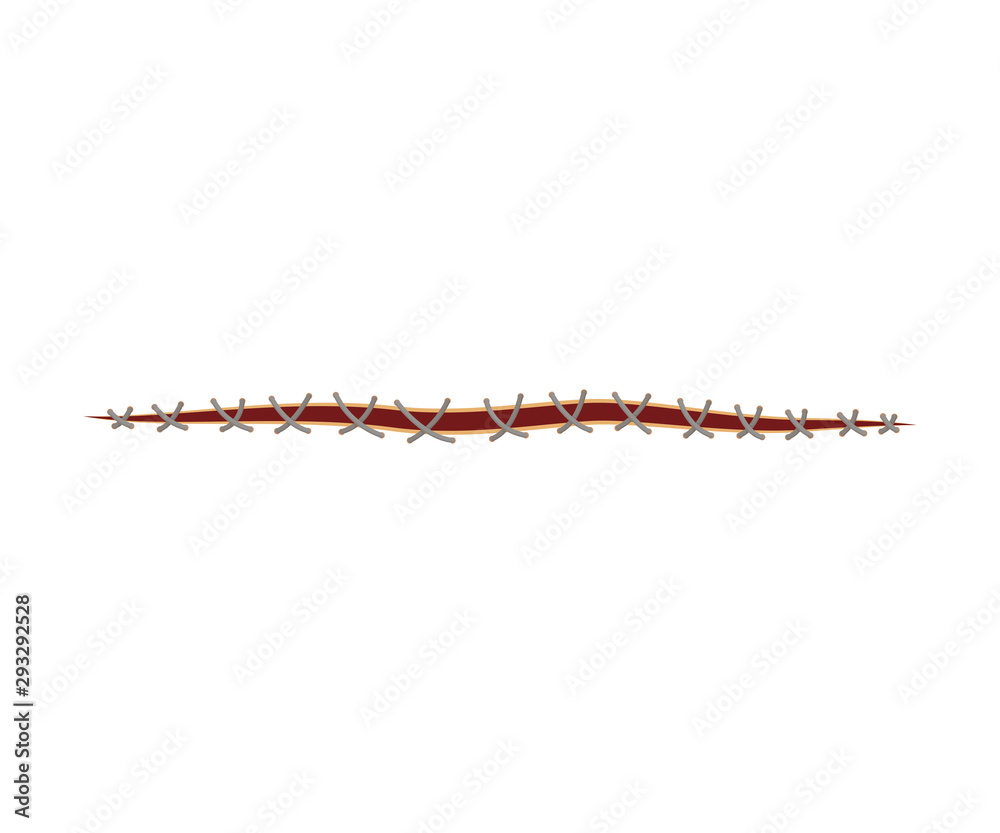 Method Of Surgical Suture For Wound Isolated On White Background Stock ...