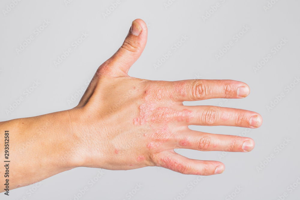 Man with sick hands, dry flaky skin on his hand with vulgar psoriasis ...