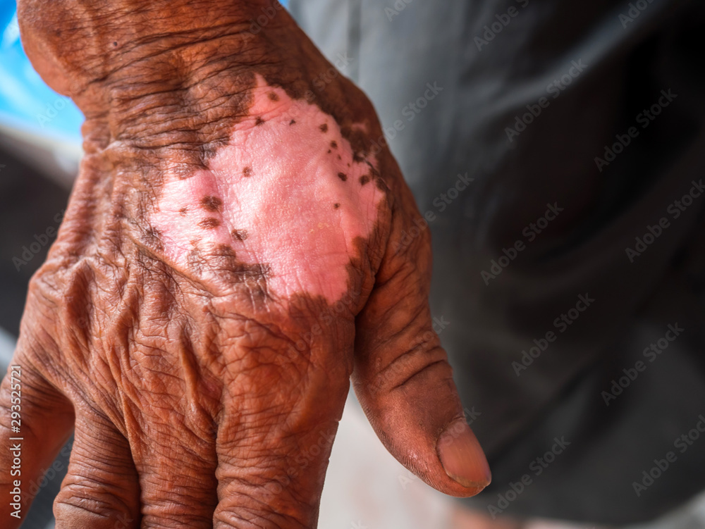 White spotted skin disease on arms asian man.The skin fungus is very ...