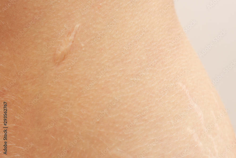 scar on the skin from surgery and stretch marks on the skin Stock Photo ...