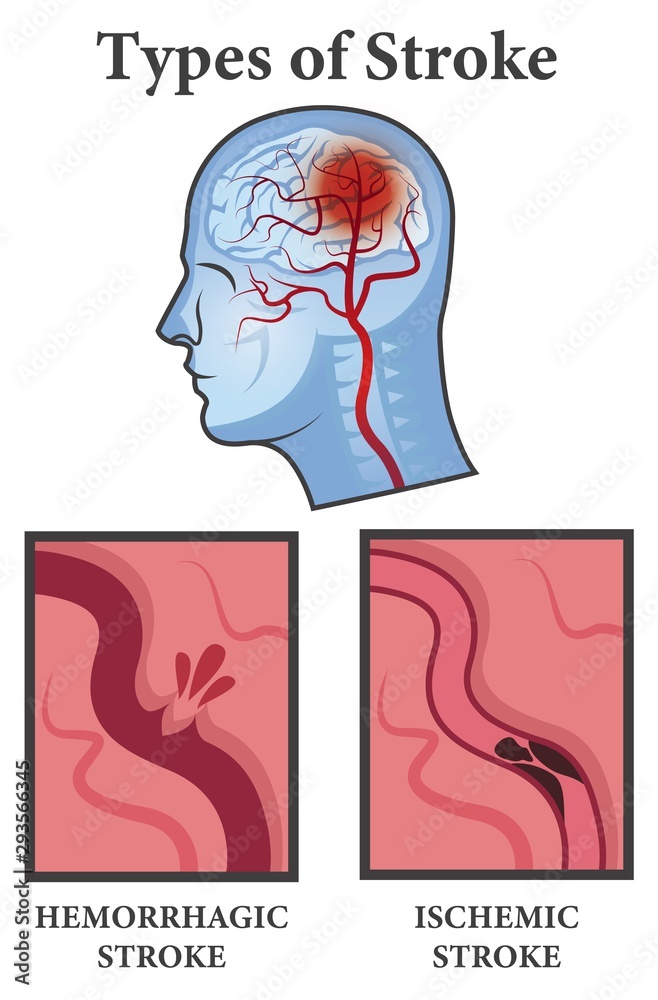 Vector illustration of Brain Stroke Types. Ischemic and Hemorrhagic ...