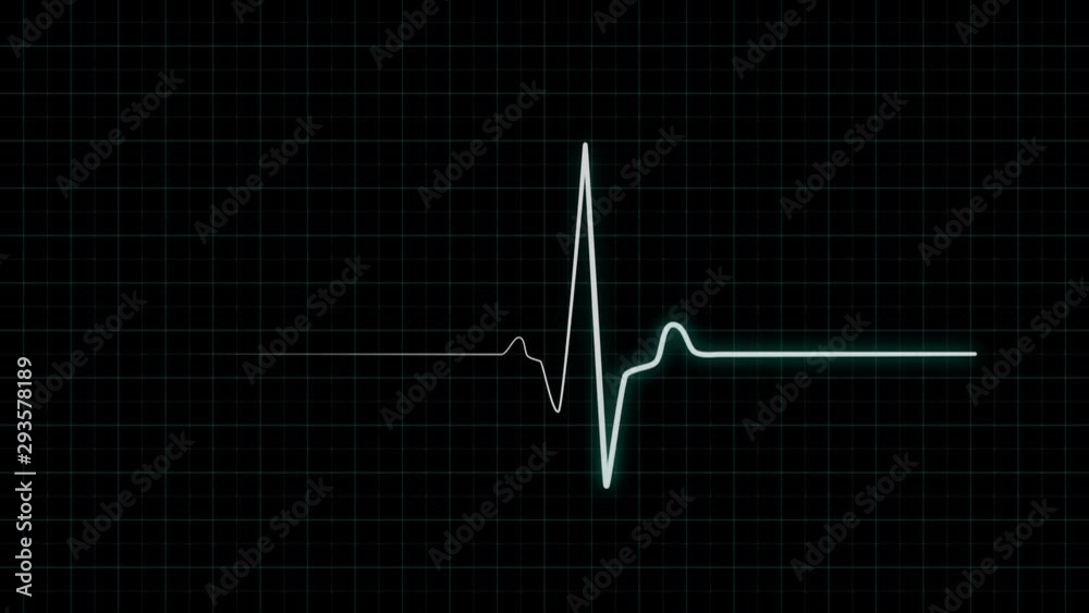 Vidéo Stock Cardiac arrest on a medical monitor. Recovery heart rate ...
