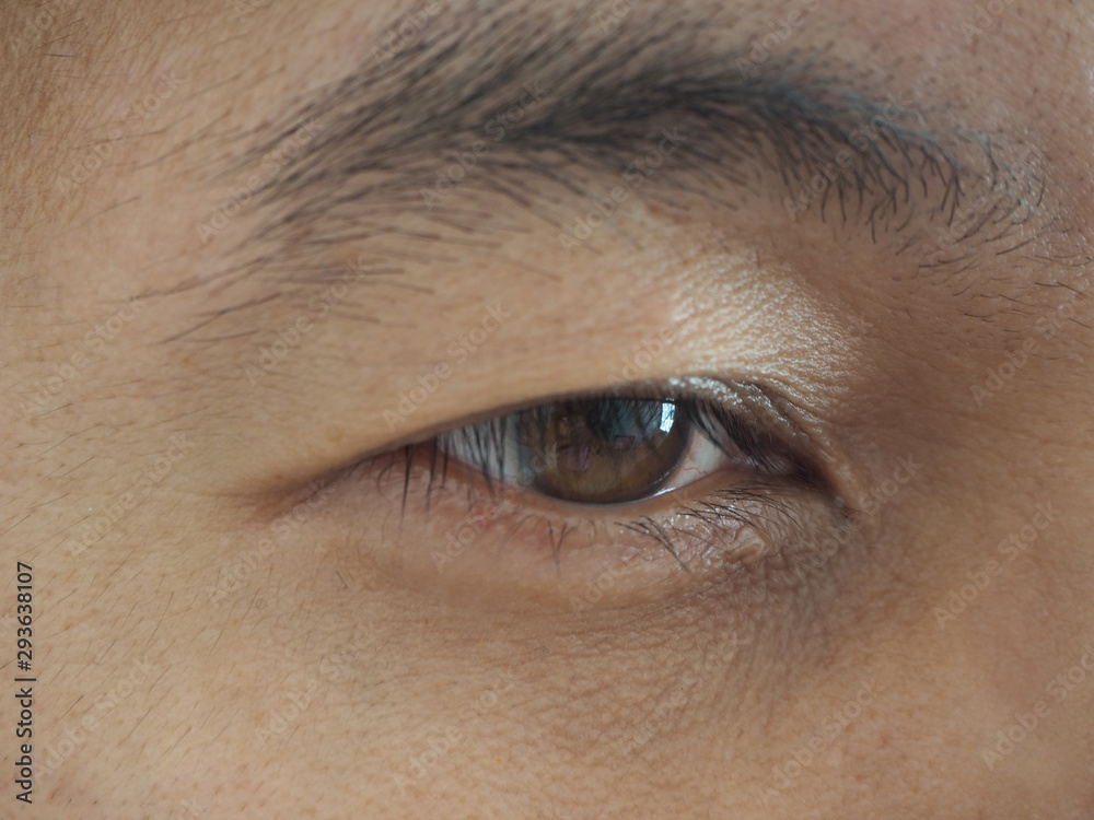 drooping eyelid or ptosis and dry eye in asian man cause of muscles ...