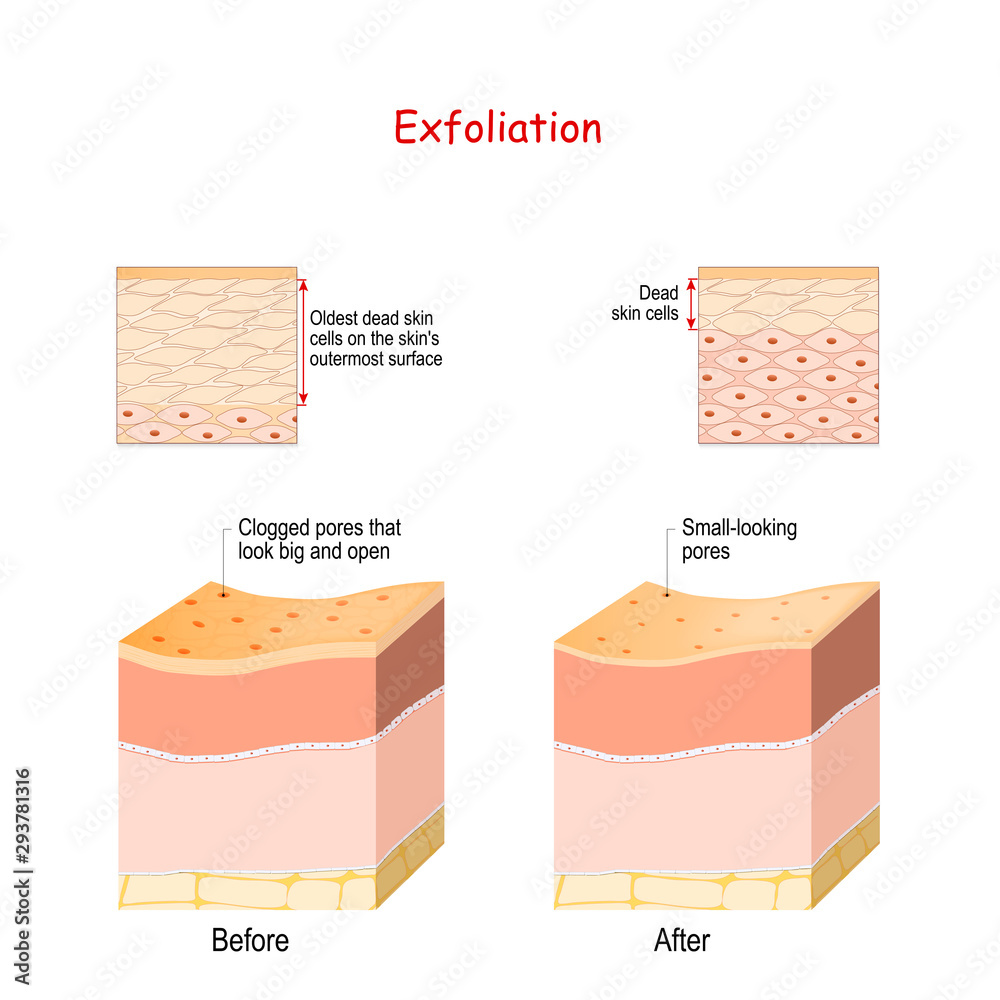 Cross-section of skin layers before and after Exfoliation Stock Vector ...
