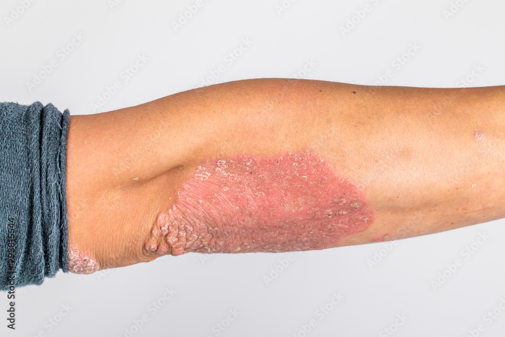Man with sick hands, dry flaky skin on his hand with vulgar psoriasis ...