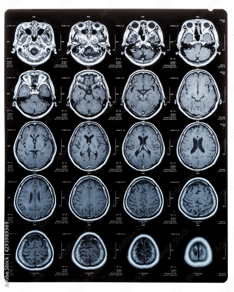 Brain scan image on Magnetic Resonance Imaging (MRI) film of elderly ...