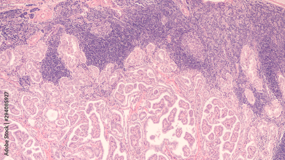 Thyroid Cancer Metastasis: Photomicrograph (microscopic image) of a ...