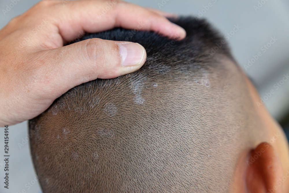 Close Up Skin Head Scalp Photos Of Dermatitis And Eczema Skin Problems Dermatology Stock