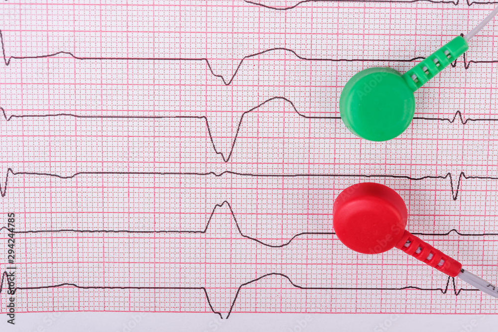 6/12 ECG or EKG printout with extrasystole and two ECG cable button ...