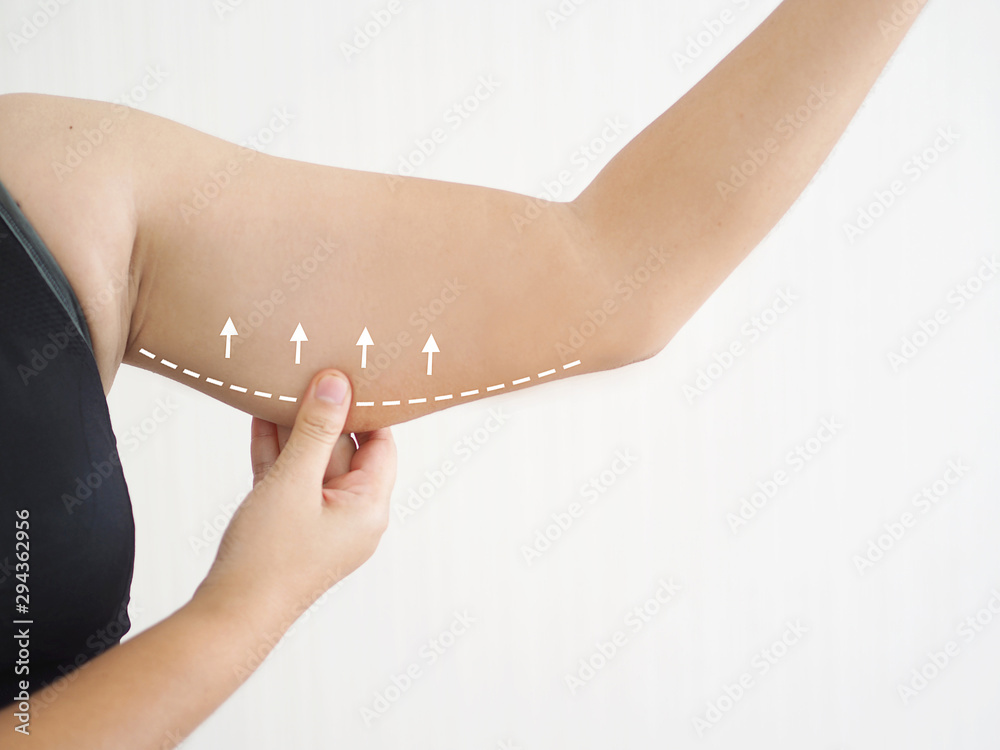 cellulite in asian woman and she grabbing her upper arm with drawing ...