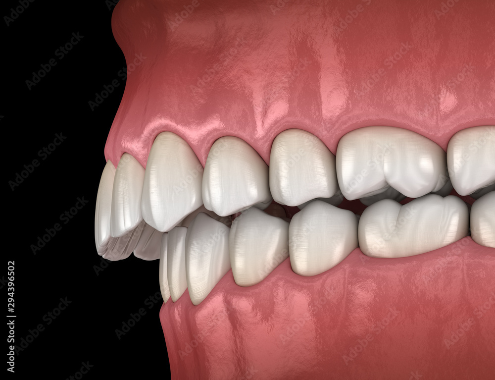 Overbite dental occlusion ( Malocclusion of teeth ). Medically accurate ...