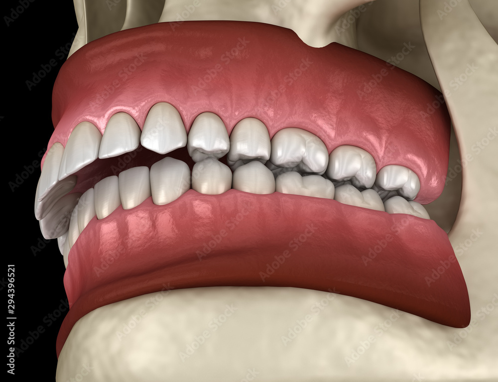 Overbite dental occlusion ( Malocclusion of teeth ). Medically accurate ...